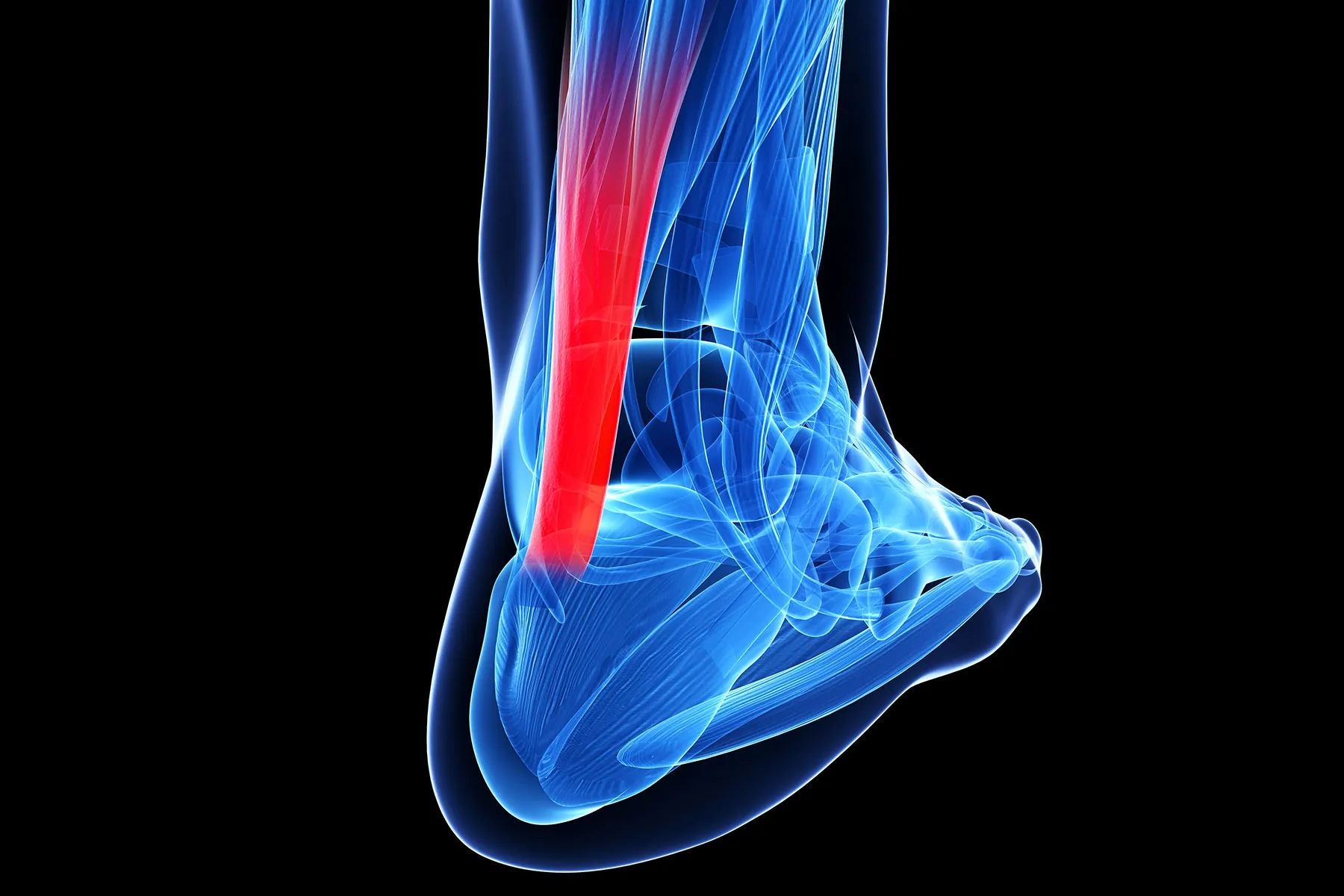 Achilles Tendon Injuries (Tear, Rupture) Causes, Symptoms, Treatments