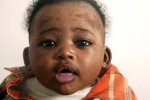 Cradle Cap: Causes, Symptoms, and Treatment