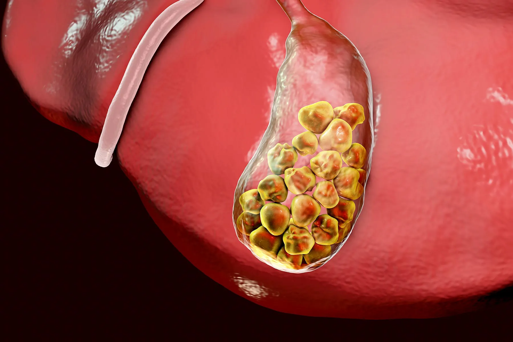 Gallstones (Cholelithiasis): Symptoms, Causes, and Treatments