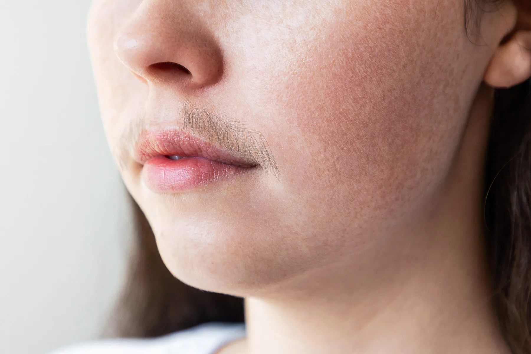 Hirsutism: Causes, Treatments for Excessive Hairiness in Women
