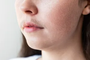 Hirsutism: Causes, Treatments for Excessive Hairiness in Women