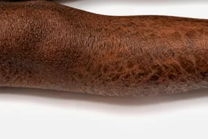 Ichthyosis: Types, Symptoms, & Treatment