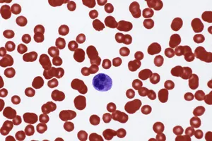 Low White Blood Cell Count: Causes and Solutions