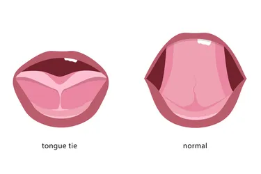 Tongue-Tie in Babies (Ankyloglossia) - Symptoms, Causes, Treatment