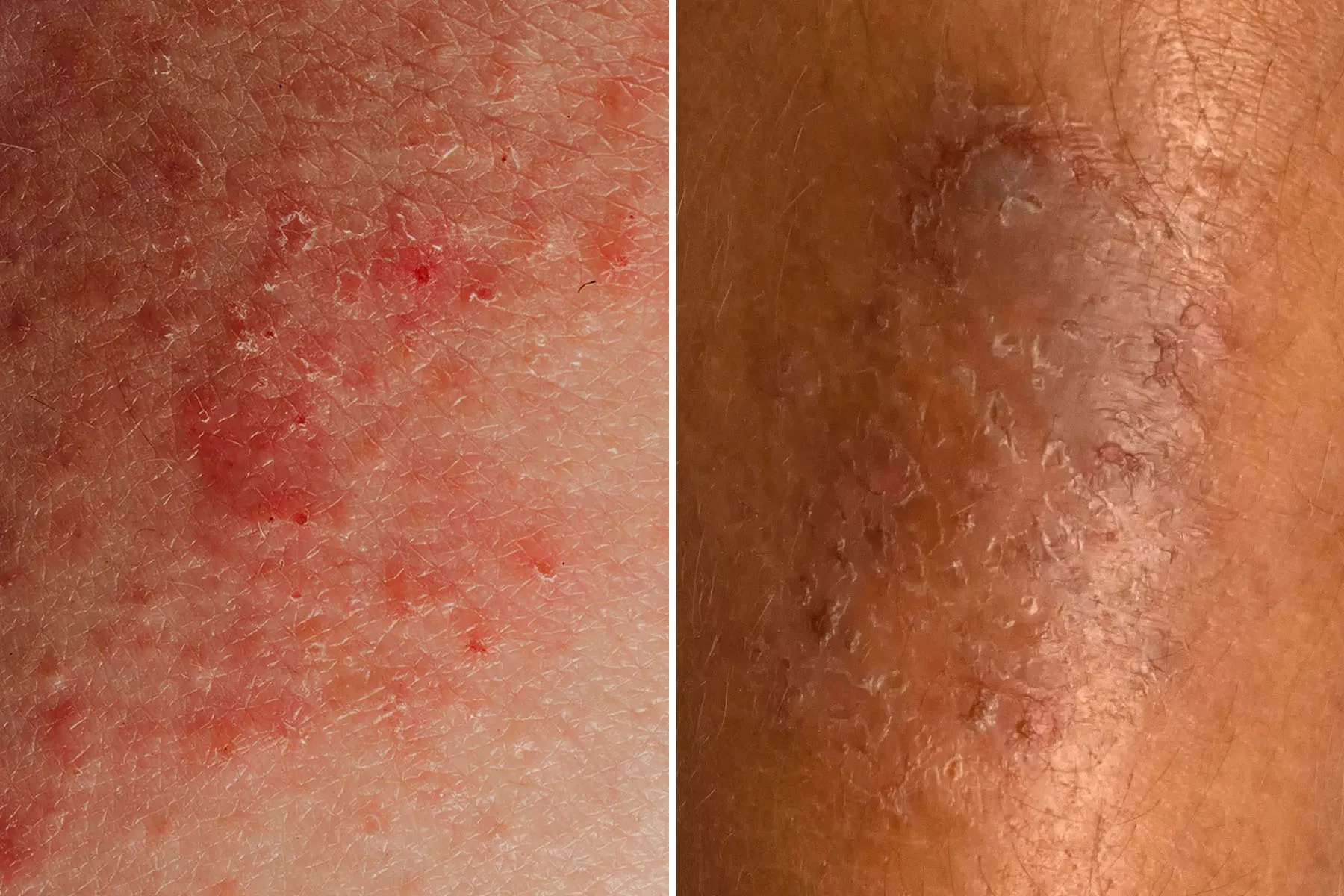 Eczema Types Symptoms Causes Diagnosis And Treatment
