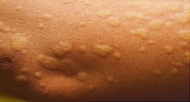What Is Chronic Idiopathic Urticaria (Hives)?