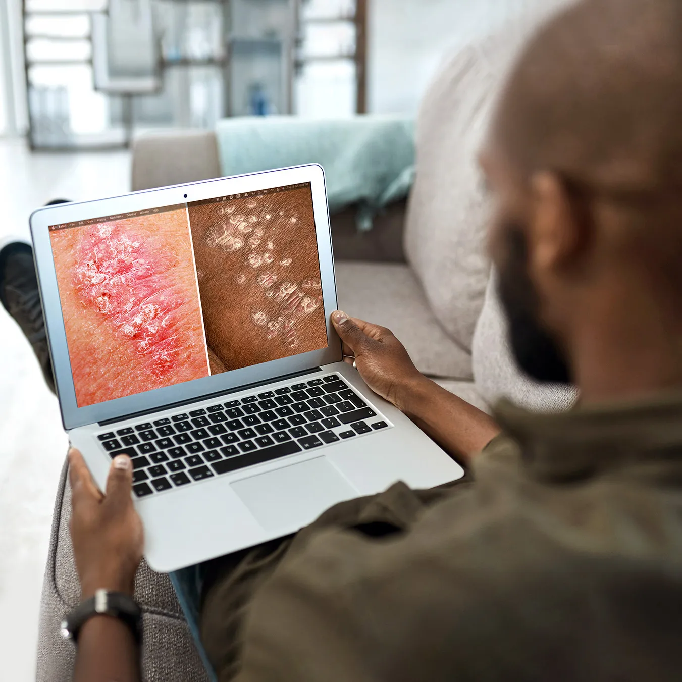 WebMD Skin Problems & Treatments Guide: Chronic Skin Conditions