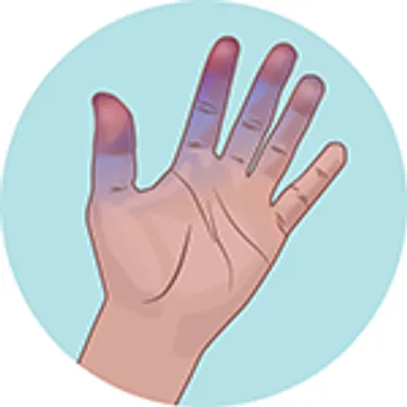 Symptoms of Poor Circulation