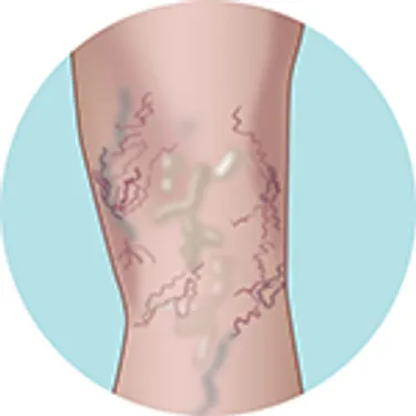 Symptoms of Poor Circulation