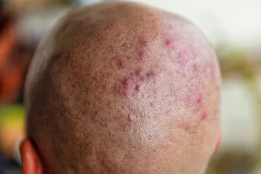 Why You Get Scalp Pimples: Causes and Treatments