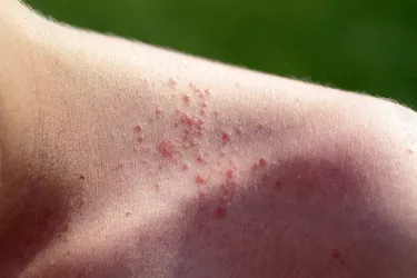 Heat Rash (Prickly Heat): Causes, Symptoms, and Treatment