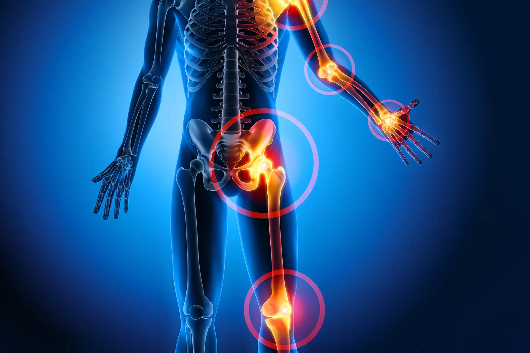 RA: Can Meds Help Prevent Joint Damage?