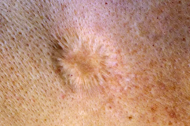 Smallpox Vaccination Scar: What to Know