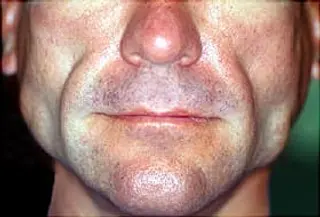 Acquired Lipodystrophy: Causes, Symptoms, Treatments