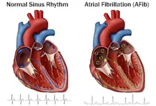 Normal Sinus Rhythm vs. Atrial Fibrillation Irregularities