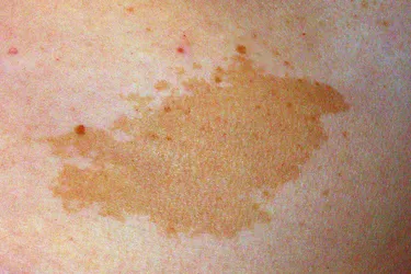 Birthmarks and Other Skin Pigmentation Problems From the Cleveland Clinic