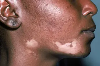 Vitiligo: Symptoms, Causes, Treatments - WebMD