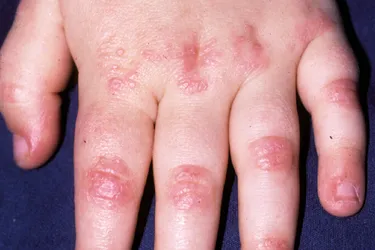 What Is Dermatomyositis? What Are the Symptoms?