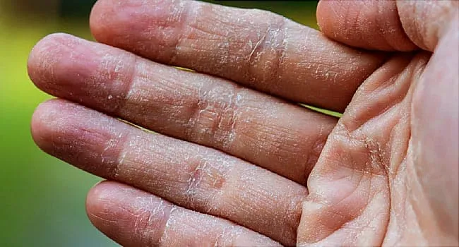 Eczema Atopic Dermatitis Symptoms Causes Triggers And Treatment
