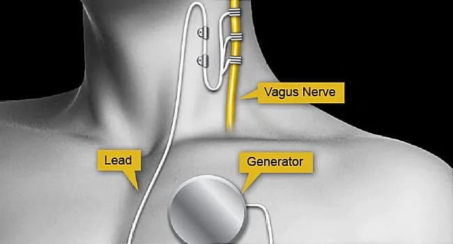 Epilepsy: Vagus Nerve Stimulation (VNS) Epilepsy: Vagus Nerve Stimulation (VNS)