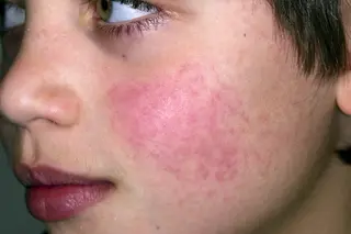 Fifth Disease (Slapped Cheek Syndrome) - Basics & Causes