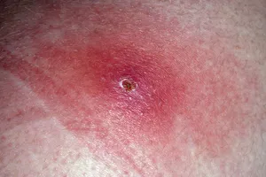 Carbuncles: Causes, Symptoms, and Treatments