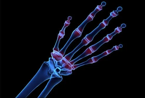 Hand and Finger RA: Finger Joint Pain and Inflammation