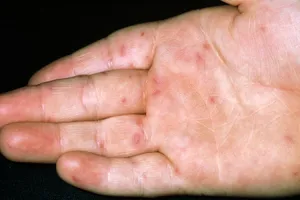 Hand, Foot, and Mouth Disease (HFMD): Rash, Symptoms, Causes, and Treatment