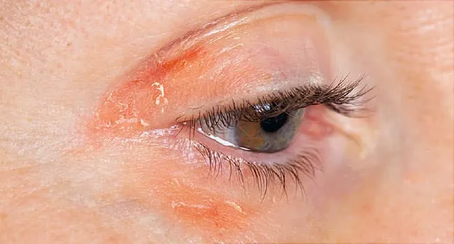 Psoriasis in Sensitive Areas: Face, Genitals, and More