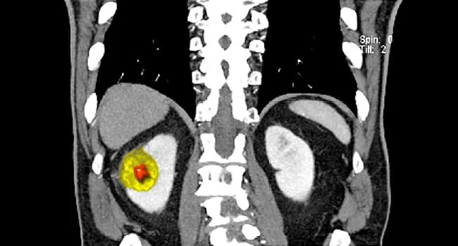Metastatic Renal Cell Carcinoma: What to Expect From Advanced Kidney Cancer
