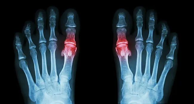 Myelofibrosis Complications: What You Need to Know