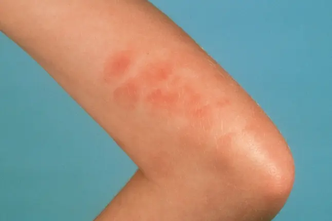 Picture of Phytophotodermatitis