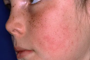 Sunburn Treatment: Photosensitivity, Light Eruption, Tips, Sunscreen