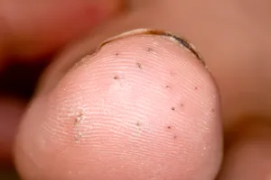 What You Should Know About Sea Urchin Stings: Symptoms and More