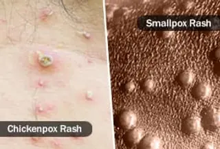 Smallpox vs. Chickenpox: 5 Ways to Tell the Difference