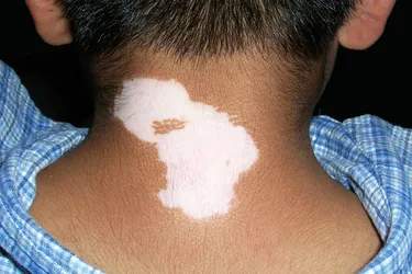 Vitiligo: Symptoms, Causes, Treatments - WebMD
