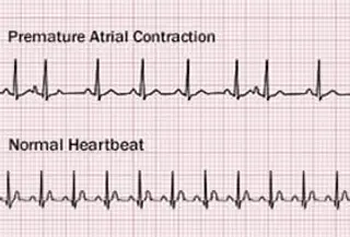 Premature Atrial Contractions: Causes, Symptoms, Diagnosis, Treatment