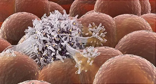 When Colon Cancer Spreads to Your Bones: Symptoms, Diagnosis, Treatment ...