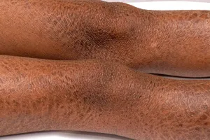 What Is Ichthyosis? And How Can I Treat My Skin?