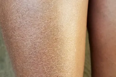 Xerotic Eczema: What it Is, What Causes it, and How it’s Treated