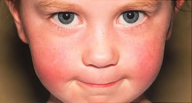 Pictures of Childhood Skin Problems: Common Rashes and More