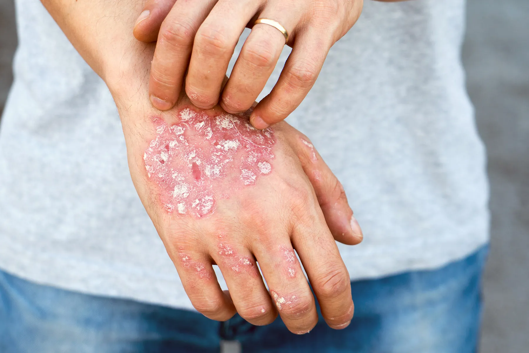 7 Types of Psoriasis: Pictures, Symptoms, Triggers, and Treatments