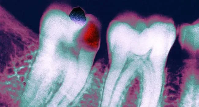 17 Mouth & Tongue Problems: Pictures of Sores, Blisters, Bumps, and More