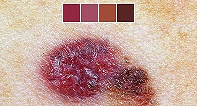 Skin Cancer Photos: What Skin Cancer & Precancerous Lesions Look Like