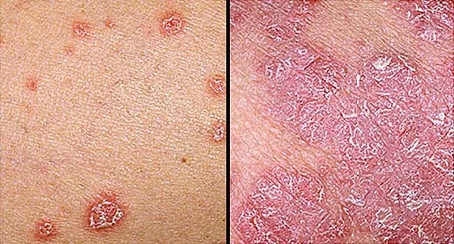 Psoriasis Pictures: A Visual Guide to Psoriasis on Skin, Nails, and More