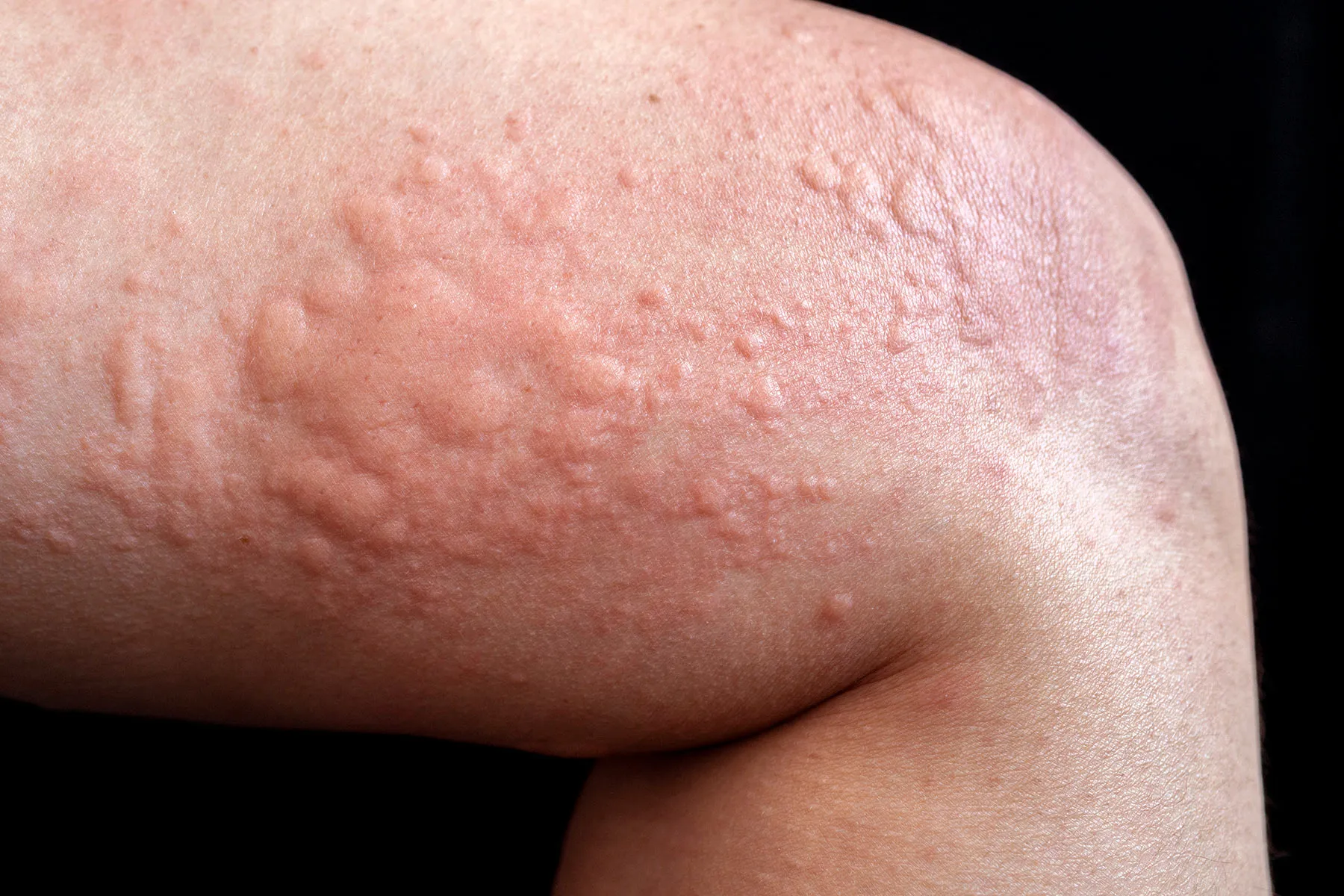 How to Manage the Itch of Chronic Spontaneous Urticaria