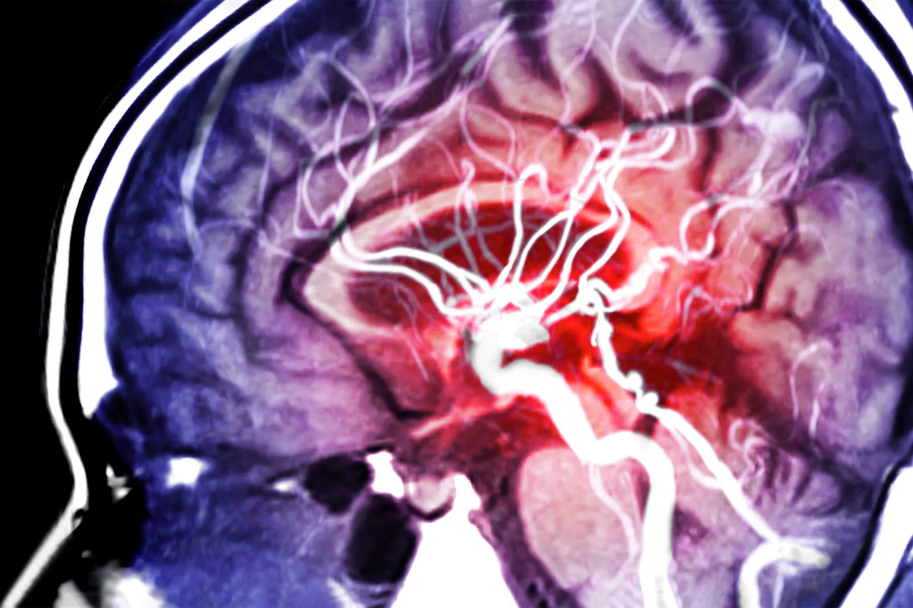 A Visual Guide to Understanding Stroke