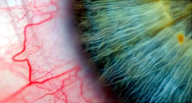 Pictures of Uveitis: Symptoms, Causes, and Treatments