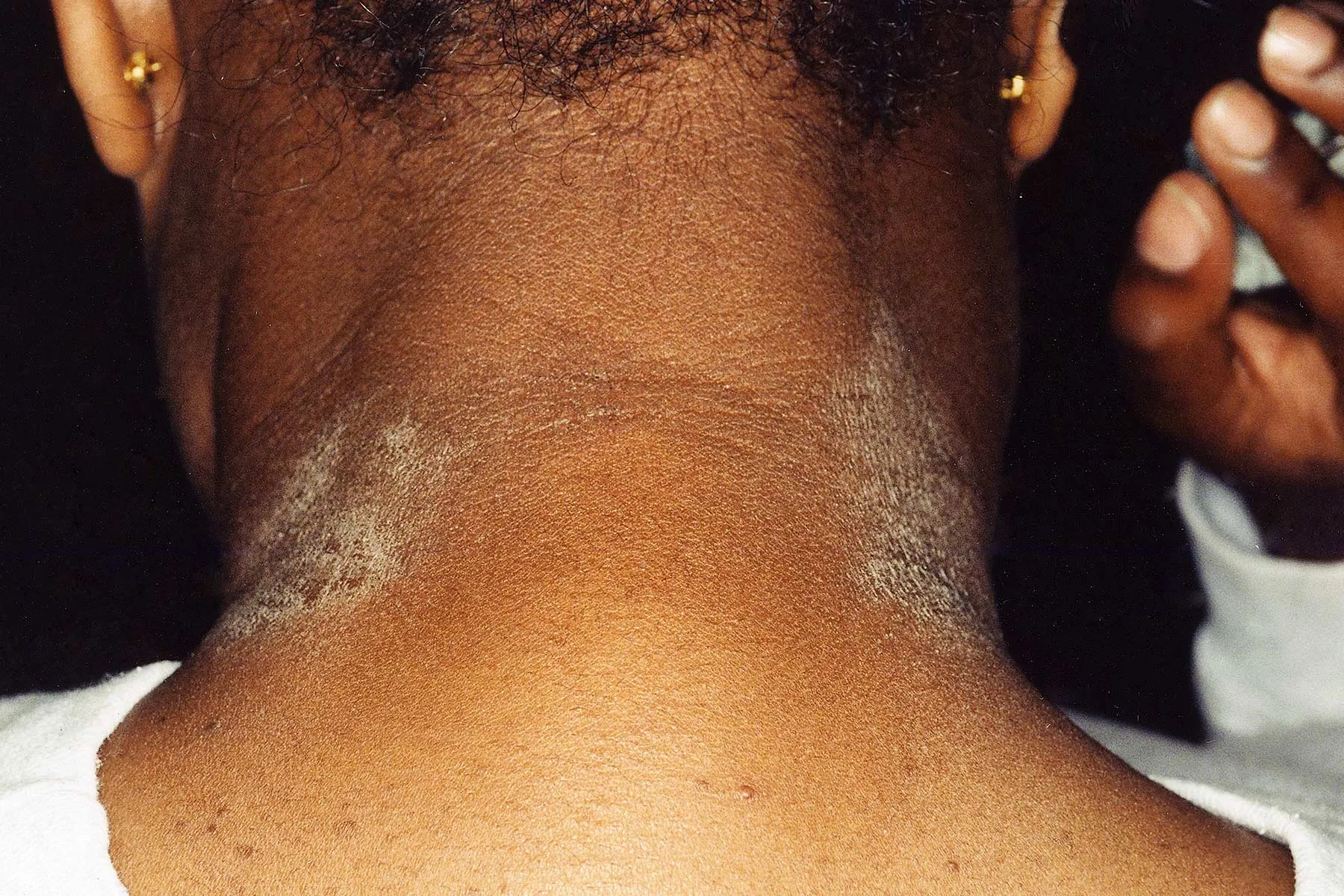 Eczema Pictures What An Eczema Rash Looks Like