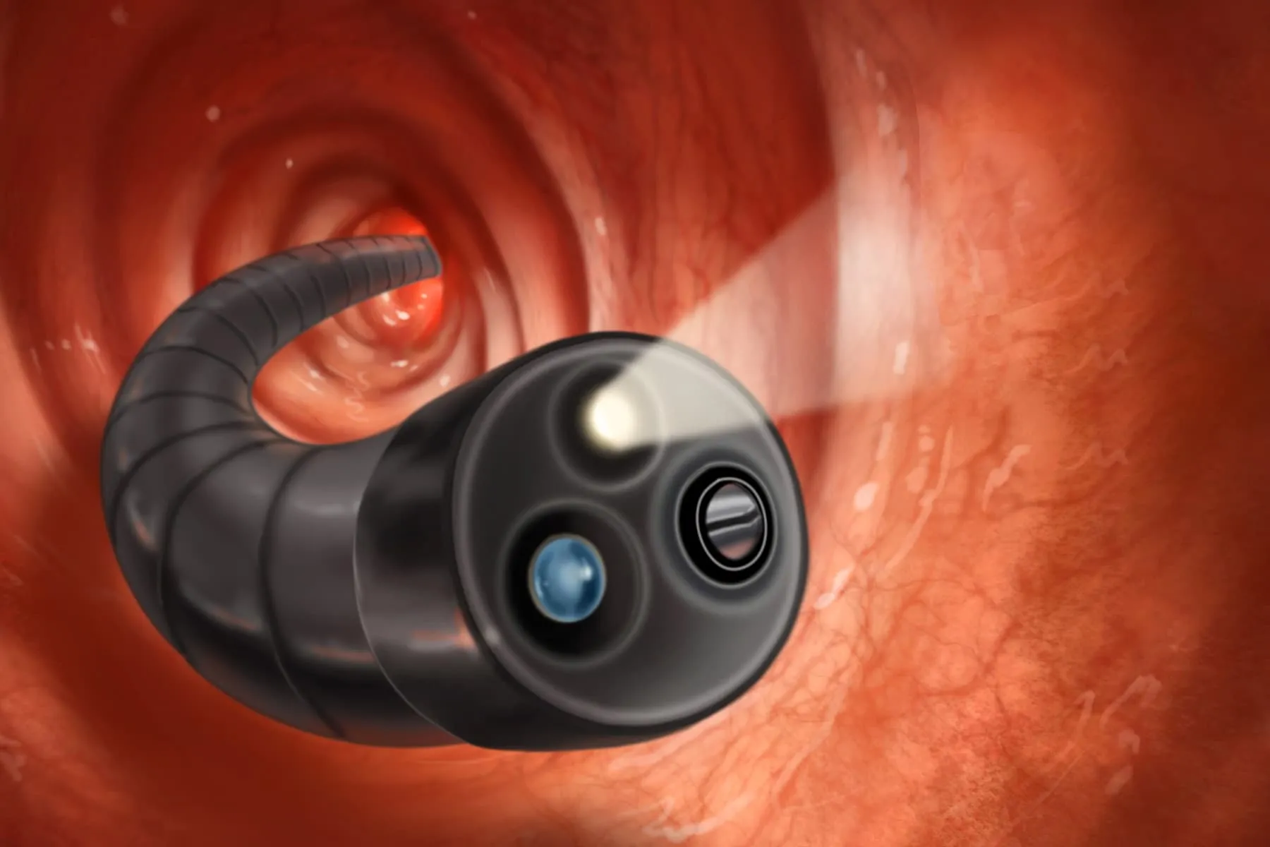Colonoscopy How To Prepare How It Feels